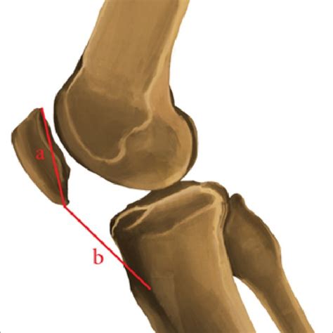 Patella Types According To Baumgartl Classification Type 1 Both