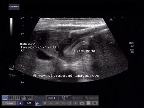 Pylorus Ultrasound