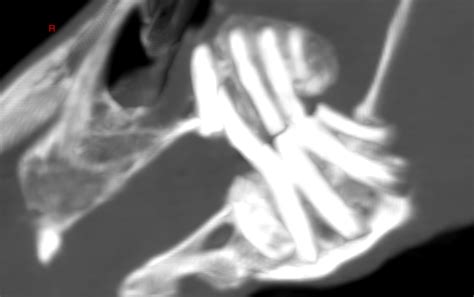 Ct Bilateral Otitis Externa And Mild Left Sided Otitis Media Wth Moderate Hydrocephalus