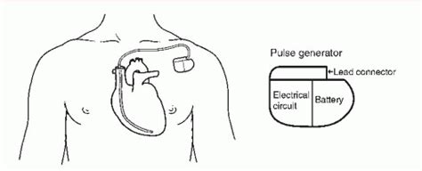 Pacemakers Thoracic Key