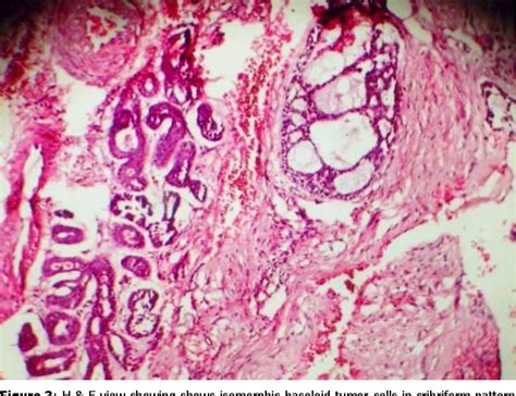 Figure 1 From Adenoid Cystic Carcinoma Of The Palate Case Report And Review Of Literature