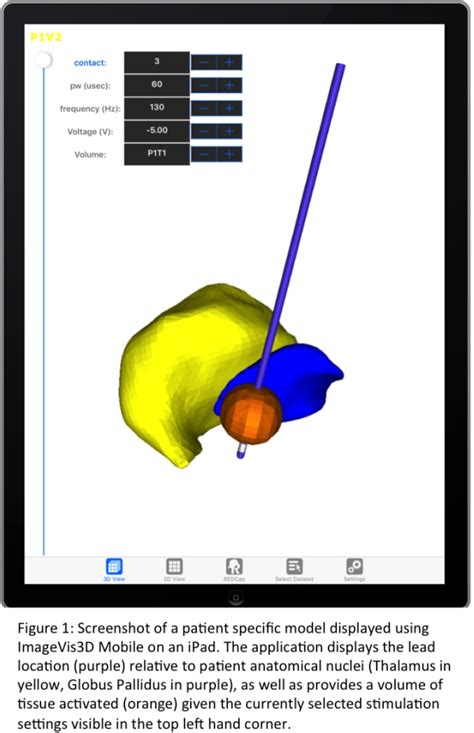Mobile Decision Support System For Nurse Managment Of Deep Brain Stimulation Mds Abstracts