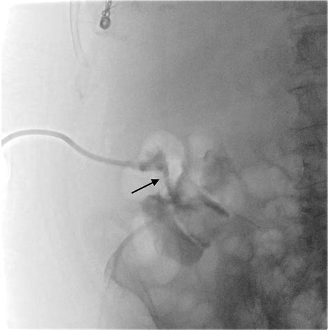 Lessons In Ir Hepatocolonic Fistulization Due To Microwave Ablation Of