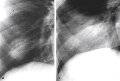 Segmental And Lobar Consolidations Radiology Key