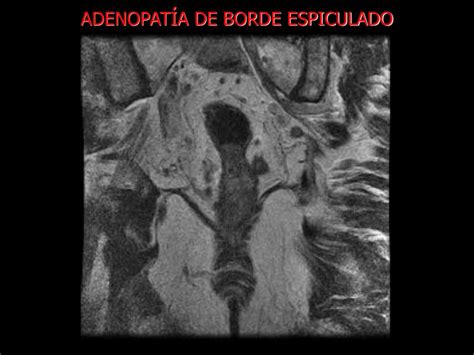 Ppt Estadiaje Del Carcinoma De Recto Por Rmn Nuestra Experiencia