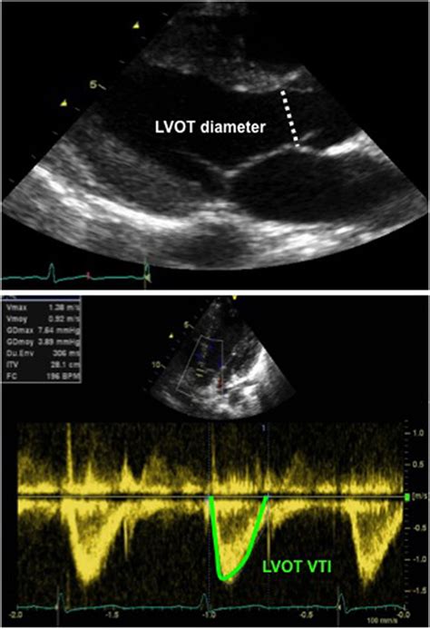 How To Measure Lvot Diameter Echo At Stan Denham Blog