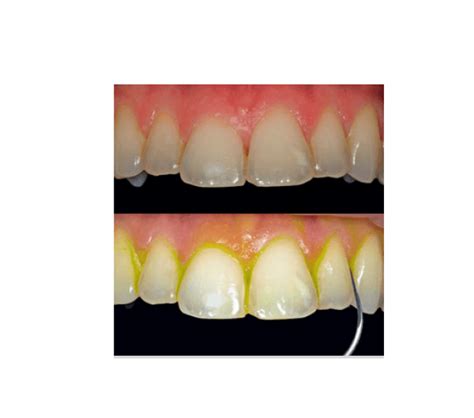 Newtron P5 Ultrasonic Scaler Satelec