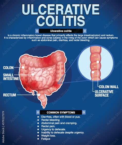 Ulcerative Colitis Symptoms Infographic Stock Vector Adobe Stock