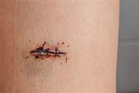 Medical Sutures Stitches After Surgery Stitched Surgical Sutures On