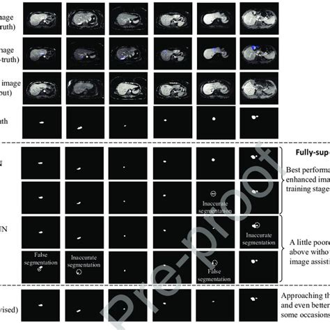 T He Tumor Segmentation Comparison Of The Wsts And Other Methods Shows Download Scientific