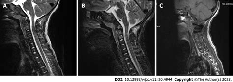 Postoperative Magnetic Resonance Imaging Of The Atlantoaxial Joint