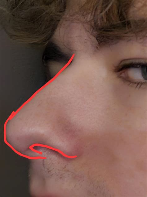 Nariz Griega Vs Nariz Romana Tipos De Narices Y Cómo La Rinoplastia
