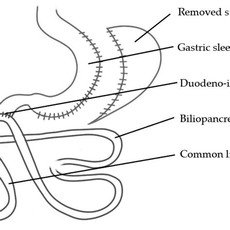 Single Anastomosis Duodeno Ileal Bypass Sleeve Gastrectomy Sadi S Download Scientific Diagram