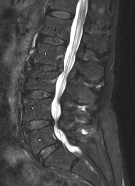 Lumbar Spinal Stenosis Spine Orthobullets