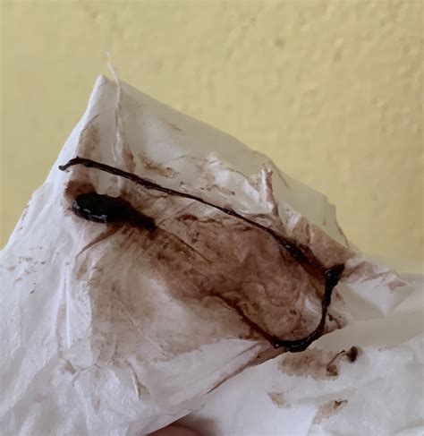 Light Implantation Bleeding With Clots Implantation Bleeding Vs