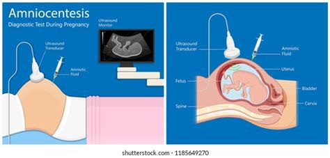 Amniotic Fluid Sample