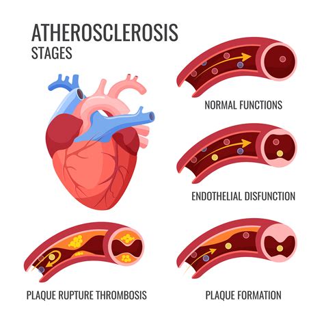 Atherosclerosis And Cardiac Physiology Forest Medical Device Testing