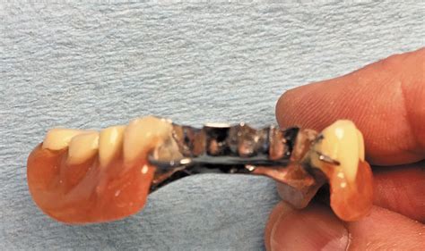 Technique An Easier Way To Repair Partial Dentures