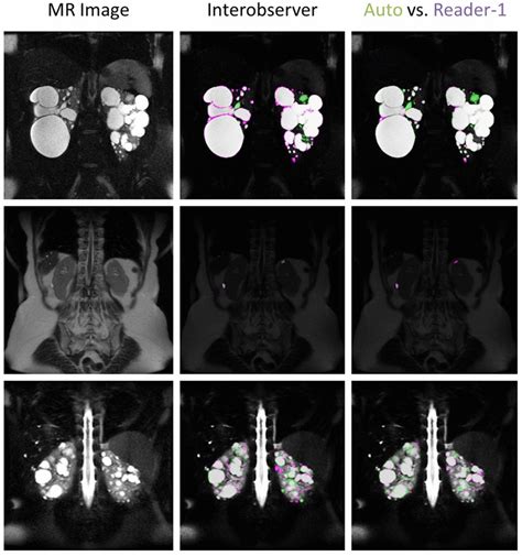 Visual Comparisons Between The Interobserver Segmentations And The