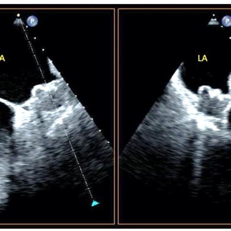 Tee Demonstration Of A Type A Device In Two Orthogonal Planes Showing Download Scientific
