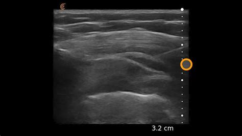 Subacromial Injection Clarius