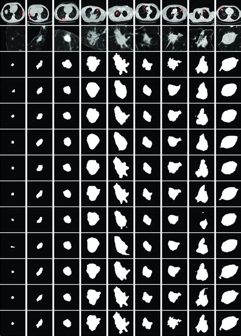 Original Images And Segmentation Results Of Pulmonary Nodules From Top Download Scientific