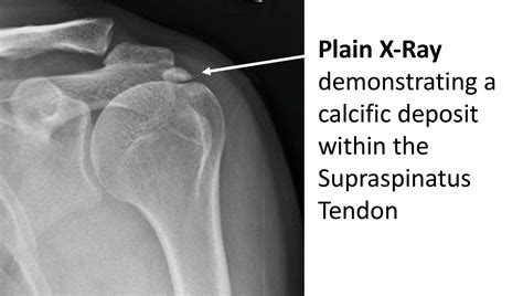 Calcifying Tendonitis And Radiological Calcification Type Resorptive