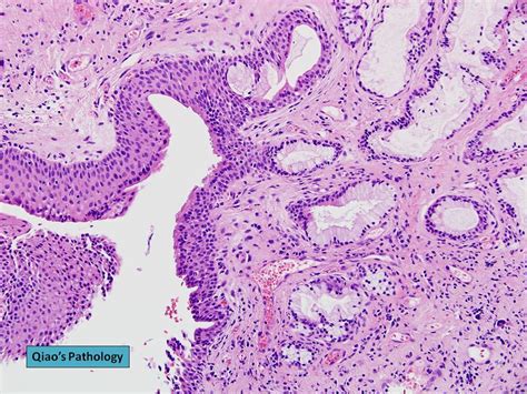 Bartholin Gland Cyst Histology Epidermal Inclusion Cyst