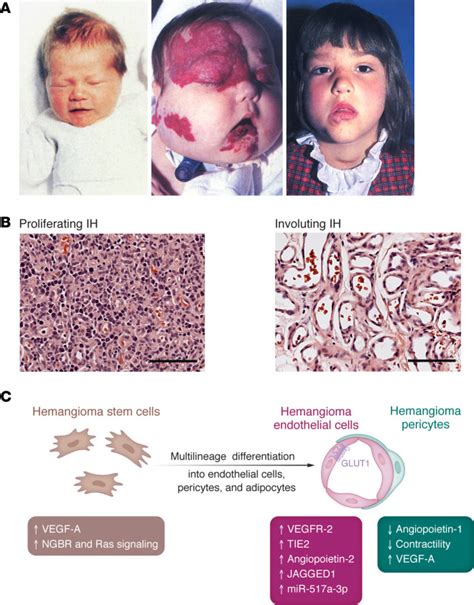Infantile Hemangioma The Common And Enigmatic Vascular Tumor Pmc