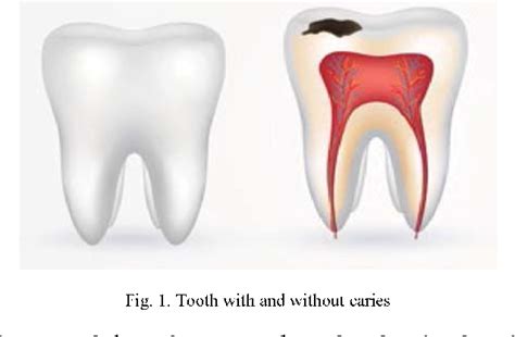 Figure 1 From Dental Caries Early Detection Using Convolutional Neural Network For Tele