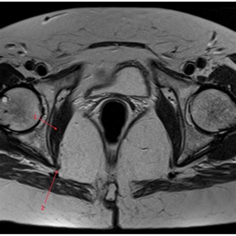 Transverse Mri T2 Weighted Image At The Level Of The Piriformis Muscle