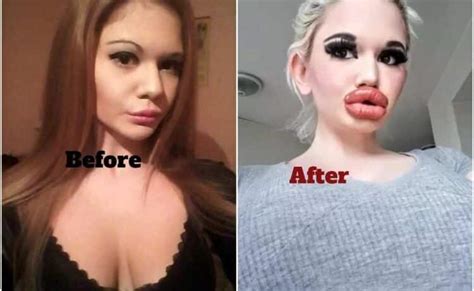 Andrea Ivanova Fait Plus De Injections Pour Avoir Les Plus Grosses