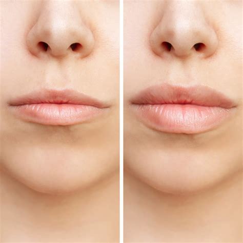 Juvederm Lips Fillers For Lips In New Jersey Soma Skin And Laser