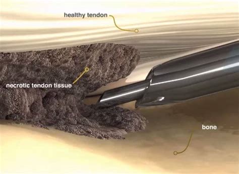 When Is Time To Impact Sports Medicine And Orthopedics
