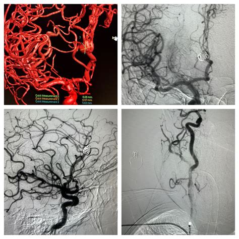 Kalyan Sajja On Linkedin 52 Year Old With Grade 2 Sah From Ruptured Aca Aneurysm S P Simple