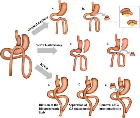 Esophagus Duodenum Gastric Bypass Surgery Improves Glucose 44 Off