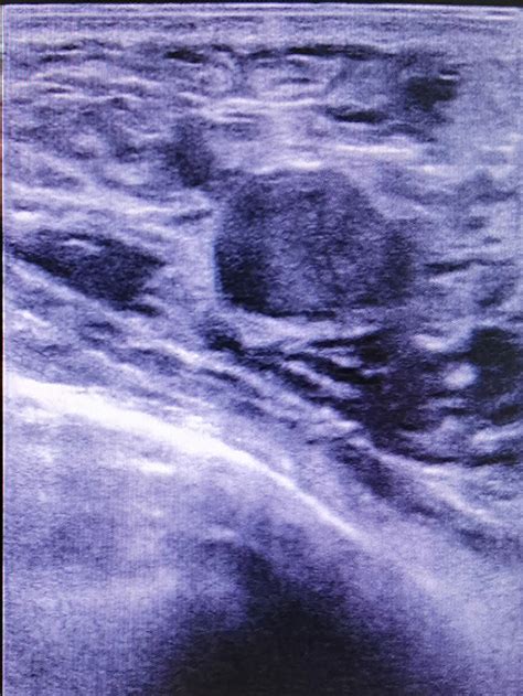 Clinical Value Of Ultrasound Guided Minimally Invasive Biopsy In The D Cmar