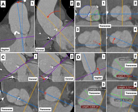 Mdct Annular Sizing In Bicommissural Non Raphe Type Bav A1 2 Align Download Scientific