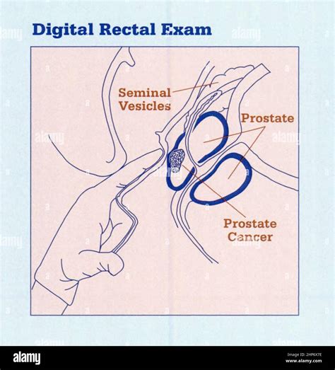 Digital Rectal Exam Ca 2000 Stock Photo Alamy Digital Rectal Exam Ca 2000 Stock Photo Alamy