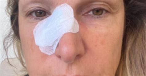 Lucille Werner Onder Het Mes Voor Huidkanker