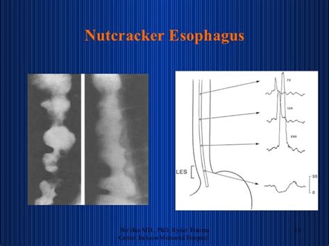 Nutcracker Esophagus High Resolution Manometry At Jennifer Wilkins Blog