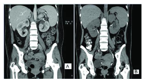 A Ct Scan Showing Emphysematous Pyelonephritis And Cystitis B Ct