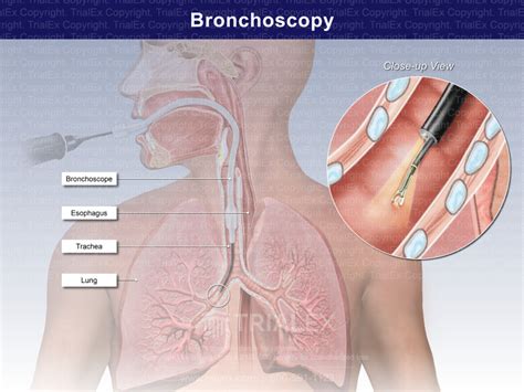 Bronchoscopy Trialquest Inc