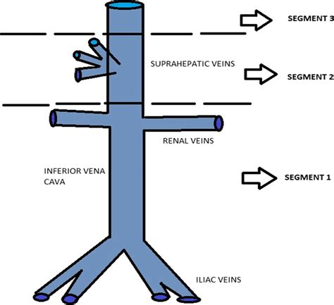 Mingolis Anatomical Classification Of Ivc Lms Download Scientific Diagram Mingolis Anatomical Classification Of Ivc Lms Download Scientific Diagram