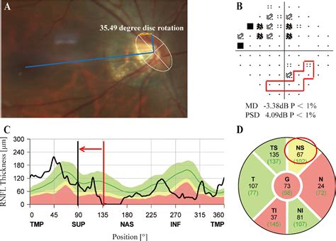 Optic Nerve Rotation In Myopic Glaucoma Misrepresents Rnfl Thickness