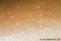 Idiopathic Guttate Hypomelanosis Dermnet Nz Anti Aging Body