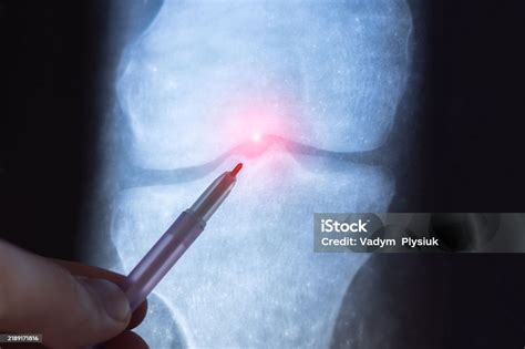 Doctor Learning Knee Joint Xray Diagnostic Of Knee Joint Pathology Detected Such Fracture