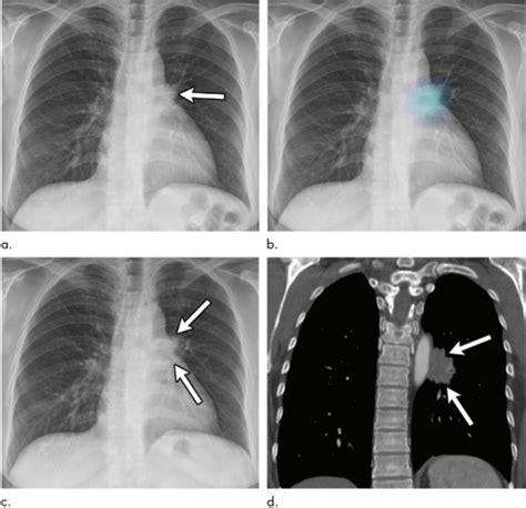 Ai Reduces Missed Lung Cancers On Chest X Ray