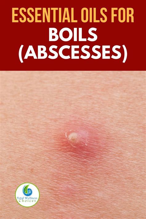 Top 5 Essential Oils For Boils Essential Oil For Boils Essential Oil