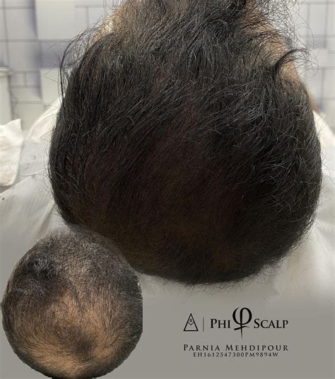 Scalp Pigmentation Euro Reflections Spa